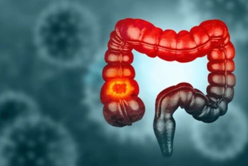 Comprehensive Colorectal Cancer Drug Monitoring - Creative Diagnostics