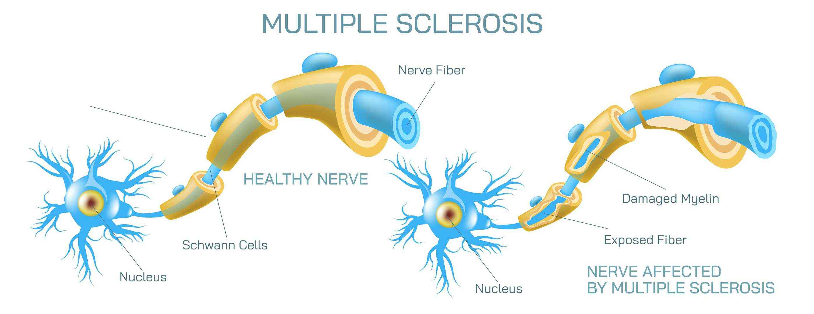 Precision Monitoring in Multiple Sclerosis Therapy - Creative Diagnostics